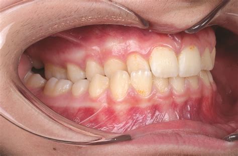 Brava A Novel Orthodontic System Resolves A Functional Shift