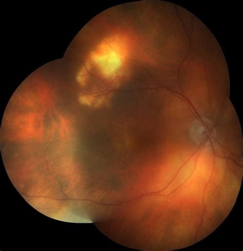 Sclerochoroidal Calcification Eyewiki
