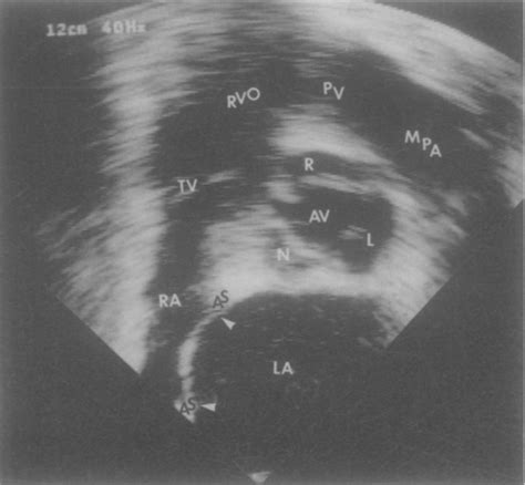 Basal Short Axis View Section 6 Left Anatomic Section Right