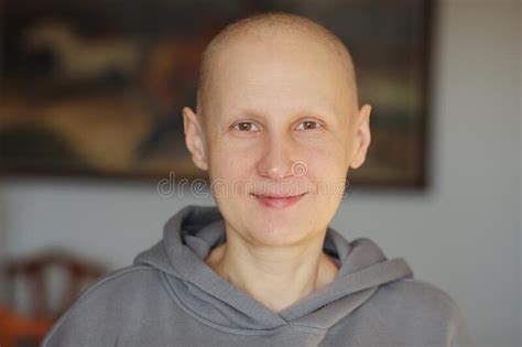 Hairless Cancer Sick Female Patient is Bleeding from Her Nose, Effects ...