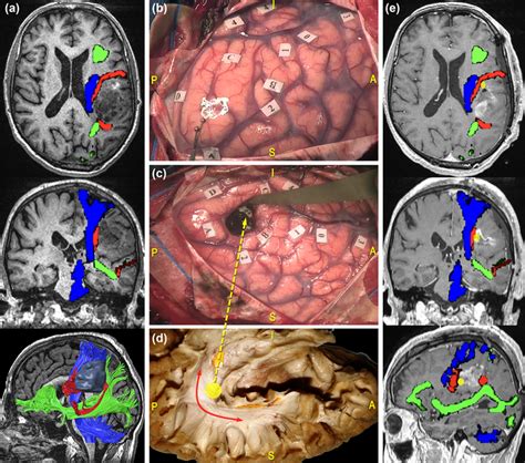 Surgical Case Concerning A 69‐year‐old Man Who Underwent Resection Of A Download Scientific
