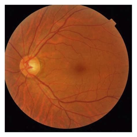 Example Fundus Images From The Ddr Dataset A Healthy Which Is Download Scientific Diagram