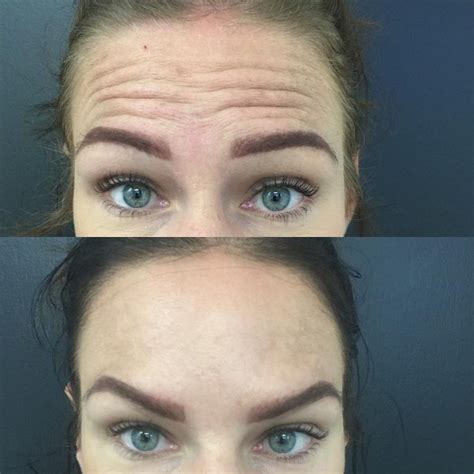 Forehead Wrinkles Treatment Injections And Lasers For Forehead Lines