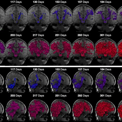 Pdf Mapping Infant Brain Myelination With Magnetic Resonance Imaging