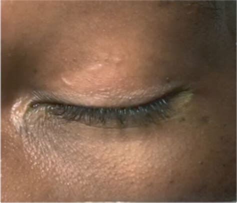 An Adult Loa Loa Worm In The Upper Eyelid An Atypical Presentation Of