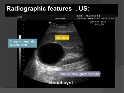 Renal Cyst Classification Of Renal Cyst Pptx