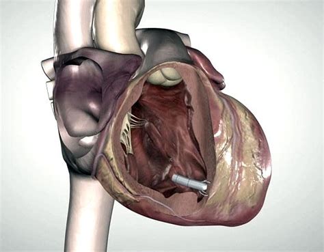 Medtronic Developing New Mini Pacemaker Minnesota Public Radio News