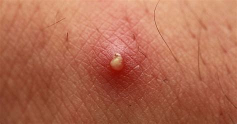 Furunculosis Neck