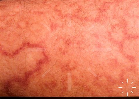 Dermacompass Urticarial Vasculitis
