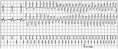 An Unusual Genetic Observation In A Case Of Short Coupled Pvc Triggered