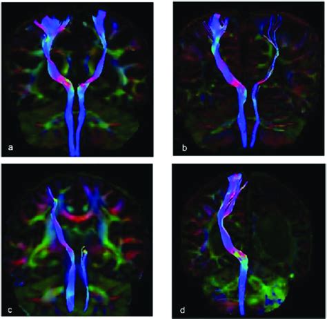 Different Patterns Of The Extracted Corticoreticular Tract Crt In