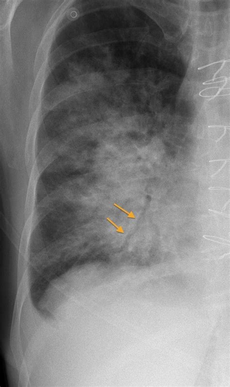 Parapneumonic Effusion Radiology At St Vincents University Hospital