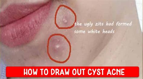 Pimple Drawing At GetDrawings Free Download