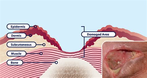 Epuap Pressure Ulcer Classification 2019 Part 1 Activheal® Academy