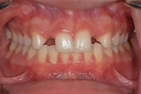 Case 2 Congenitally Missing Teeth Before And After Gallery