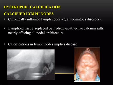 Soft Tissue Calcifications Of The Oral Cavity Pptx