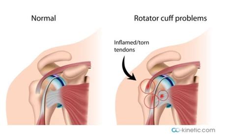 Subacromial Space