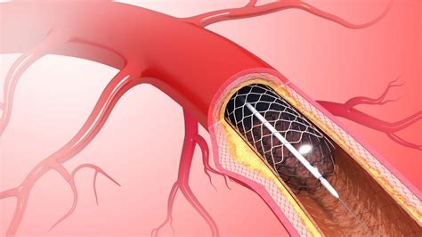 What To Expect During Genicular Artery Embolization