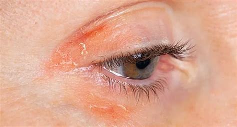 Psoriasis In Sensitive Areas Face Genitals And More