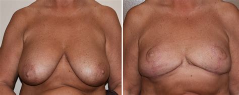 Plastic Surgery Case Study Maximal Breast Reduction In Older Female