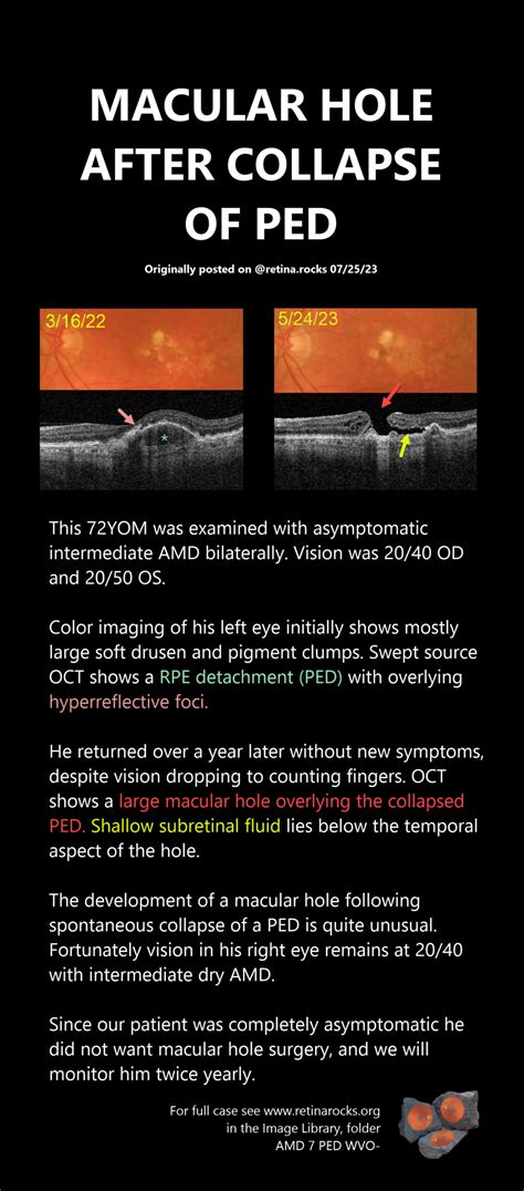 Disorders Causing Exudative And Hemorrhagic Detachment Amd Rpe