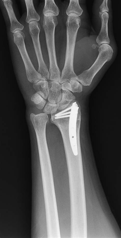 Defining The Role Of Intramedullary Nailing For Fractures Of The Distal