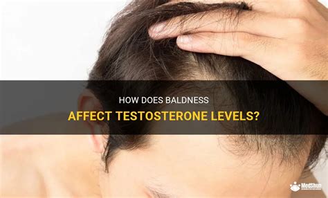 How Does Baldness Affect Testosterone Levels Medshun