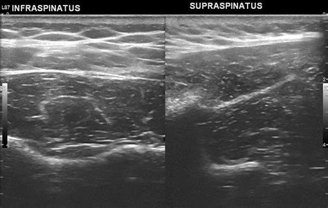 Radiopaedia Case Subscapularis Tendon Tear Preoperative And Postoperative Ultrasound Id 76646