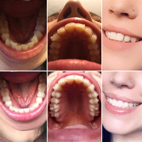 31 Trays Later Awaiting 17 Refinement Trays R Invisalign