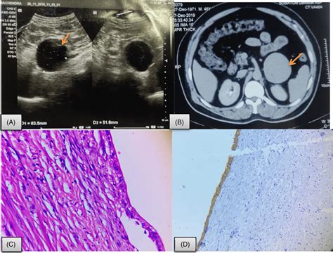 Epithelial Adrenal Cyst A Usg Abdomen Showing Arrow A Well‐defined