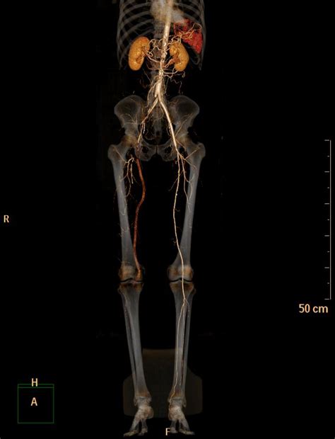 Aortobifemoral Bypass Surgery Aortobifemoral Bypass What It Is And