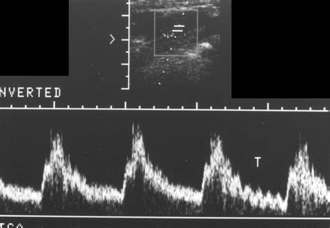 A Spectrum Of Doppler Waveforms In The Carotid And Vertebral Arteries Ajr