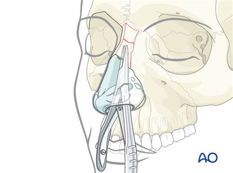 Open Reduction For Nasal Bone