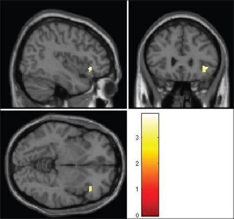 Right Orbitofrontal Cortex OFC With Significantly Deficient Download Scientific Diagram