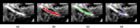 Comparison Between Spd Ransac And A Simple Model Based Ransac A Download Scientific Diagram