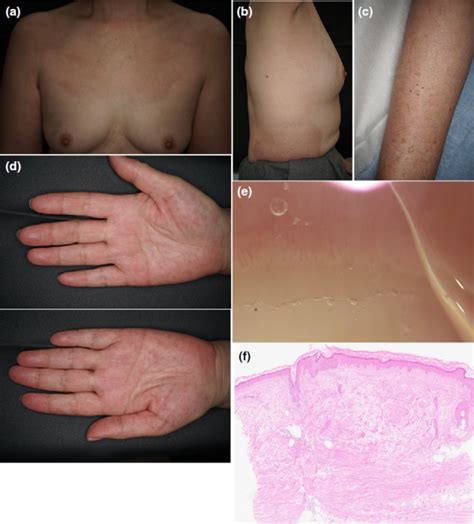 今日病例：泛发性硬斑病伴毛细血管扩张 丁香园