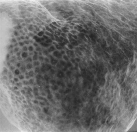 Intestinal Nodular Lymphoid Hyperplasia