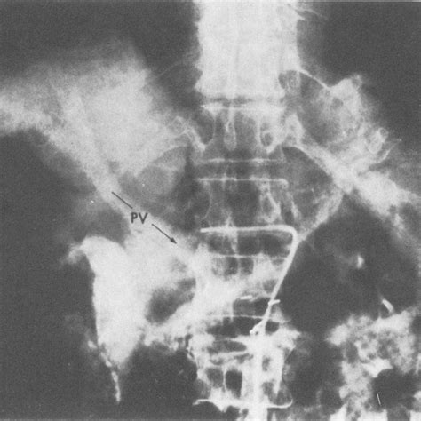 Case Venous Phase Of Common Hepatic Arteriogram Fig Download Scientific Diagram