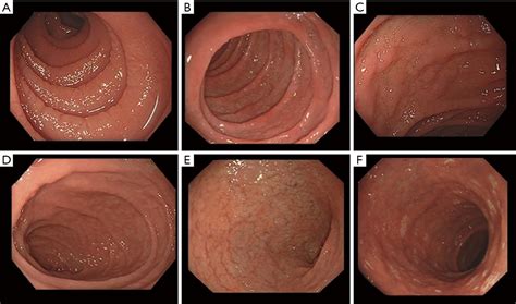 Role Of Endoscopy In The Diagnosis Of Coeliac Disease A Nar