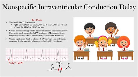 Intraventricular Conduction Delay