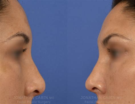 Non Surgical Rhinoplasty CabinMD Facial Plastics Aesthetics