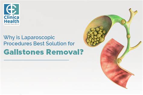 Gallstone Removal By The Best Gallbladder Surgeon In Kolkata