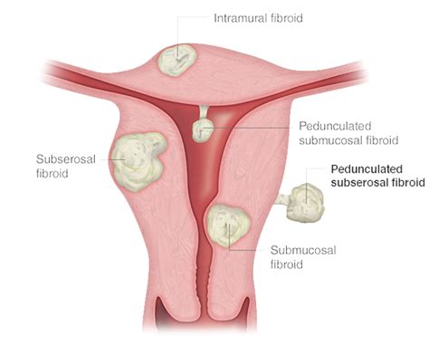 Kesan Fibroid Dalam Rahim Austin Dowd