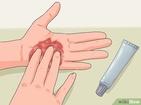 4 Ways To Treat A Hand Burn Wikihow