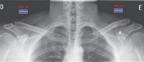 Calculation Of The Coracoclavicular Distance Of The Operated And Normal