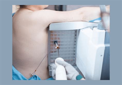 Feasibility And Advantages Of A Novel Mbi Guided Core Needle Biopsy