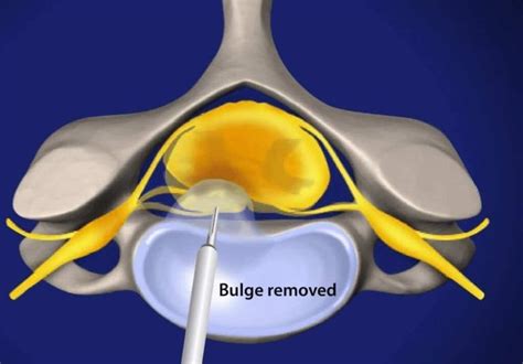 Lumbar Discectomy Aptiva Health