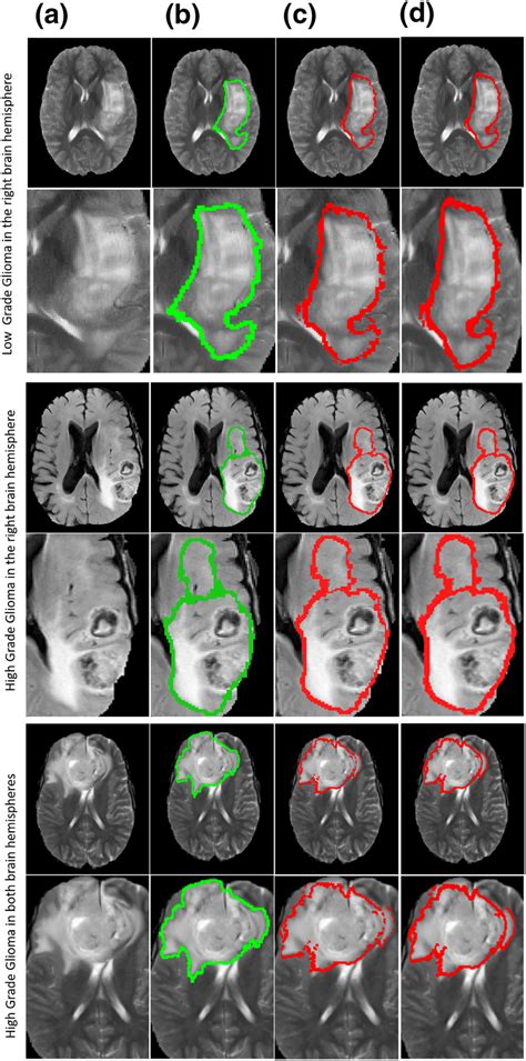 Three Examples Of Lowhigh Grade Glioma Patients From Brats Dataset