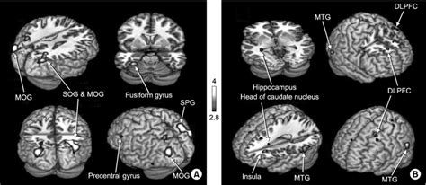 Brain Regions Predominantly Showing Increased Activation To The Fearful Download Scientific