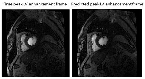 A Comparison Of The Automated And Manually Chosen Peak LV Enhancement Download Scientific